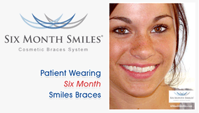 Six Month Smile Braces | Cheadle Hulme Dental & Cosmetics